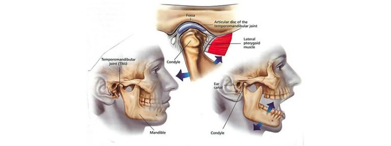 TemporoMandibular Joint Dysfunction Syndrome (TMJPDS) explained ...