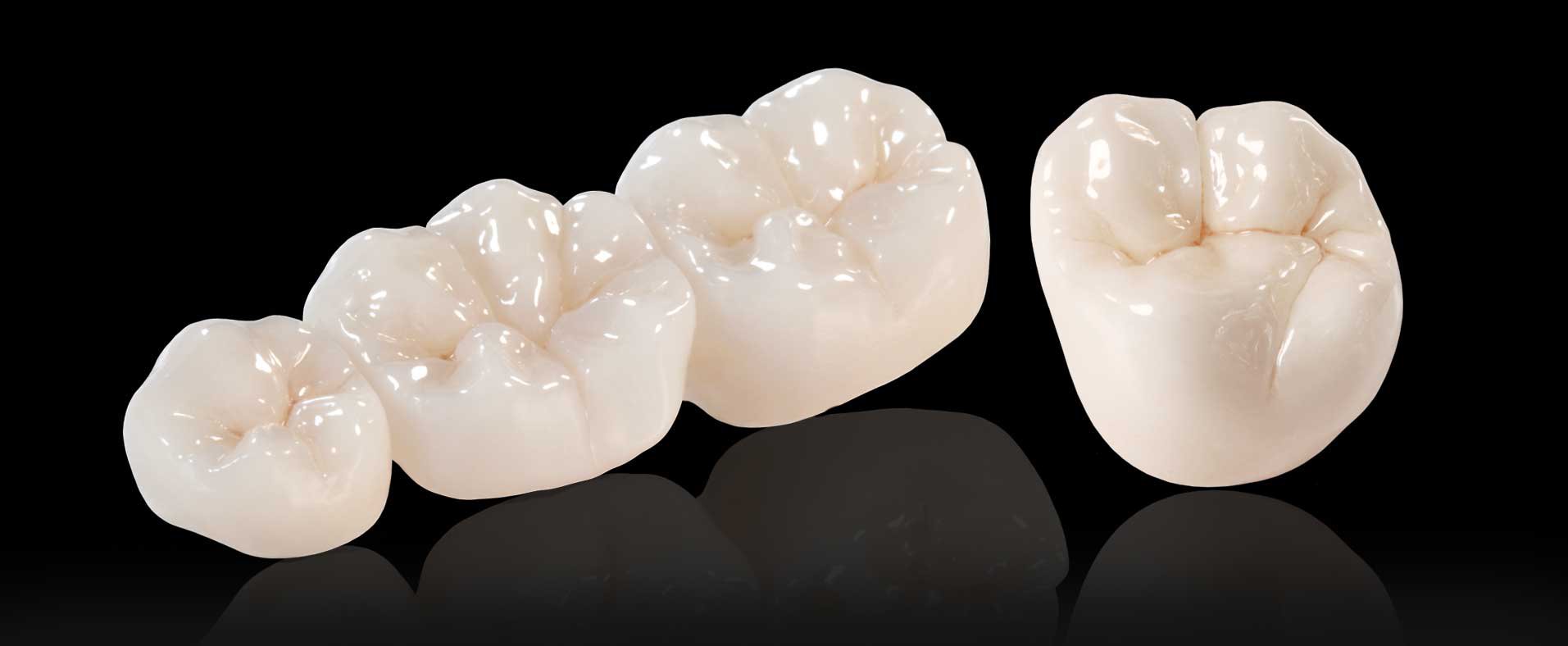 Crown and Bridge Sunnybank Hills - Aperture Dental Practice